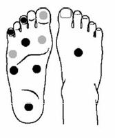 Using Monofilaments in Sensory Assessment Examinations for Diabetes ...