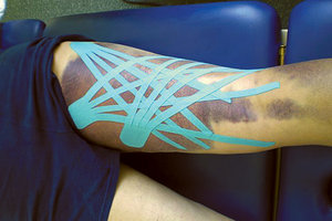 What is Kinesio tape and Why do Physical Therapists Use it ...