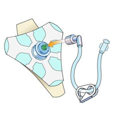 EZ-IO Stabilizer - Sedation Resource